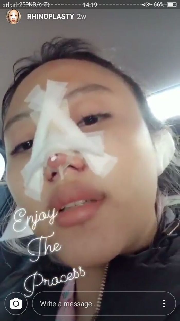 Janine Intansari Beberkan Tahap Operasi Hidungnya